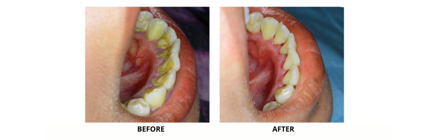 ORAL PROPHYLAXIS - Success Dental Clinic